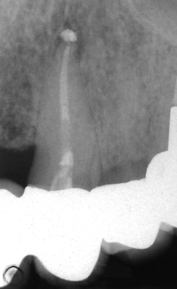 Dental News - MTA placement with the Produits Dentaires MAP System