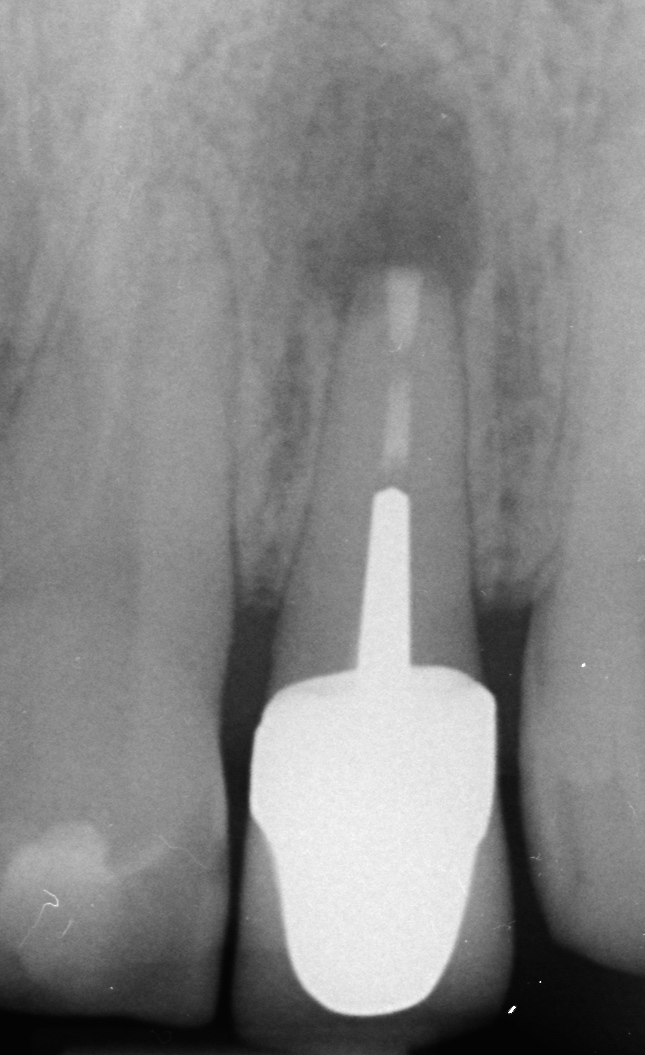Dental News - MTA placement with the Produits Dentaires MAP System