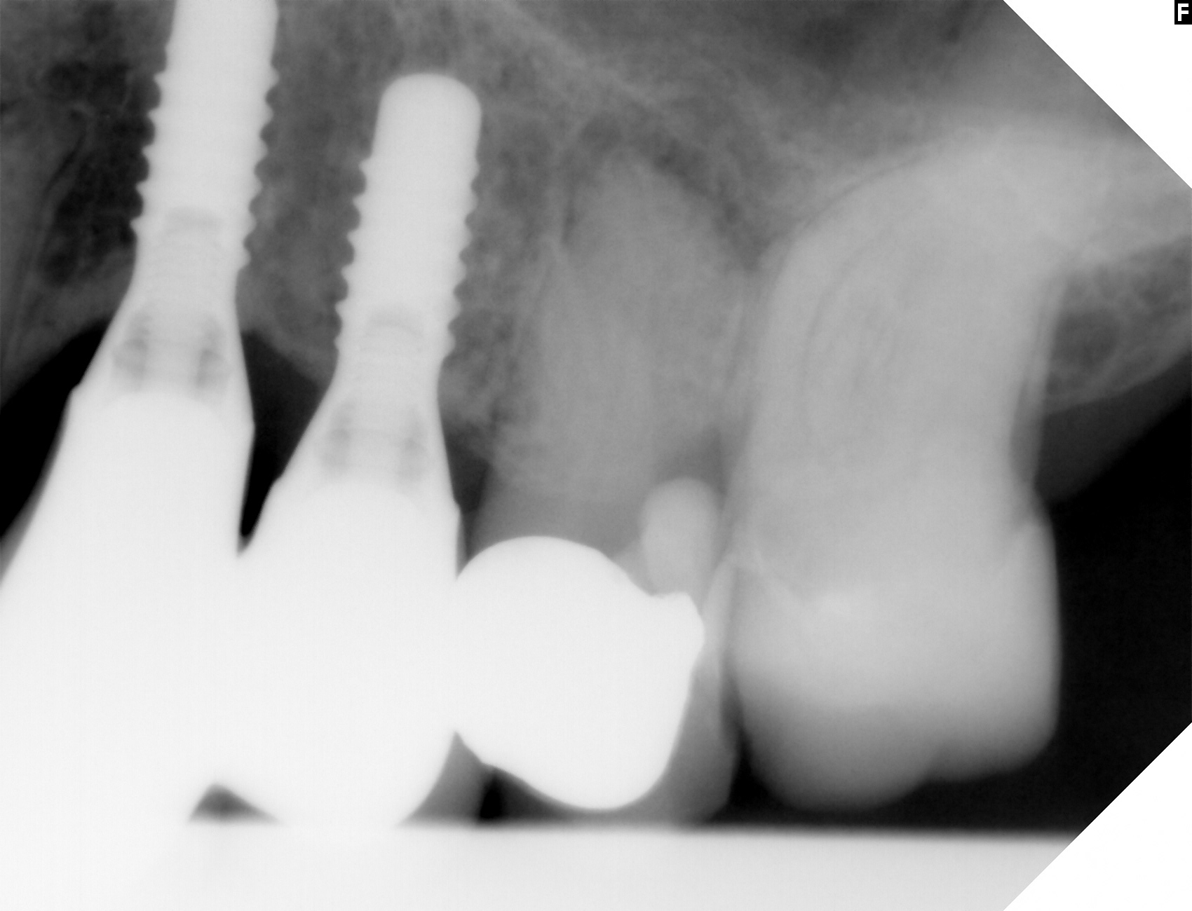 Dental News - Atraumatic extraction of maxillary second premolar