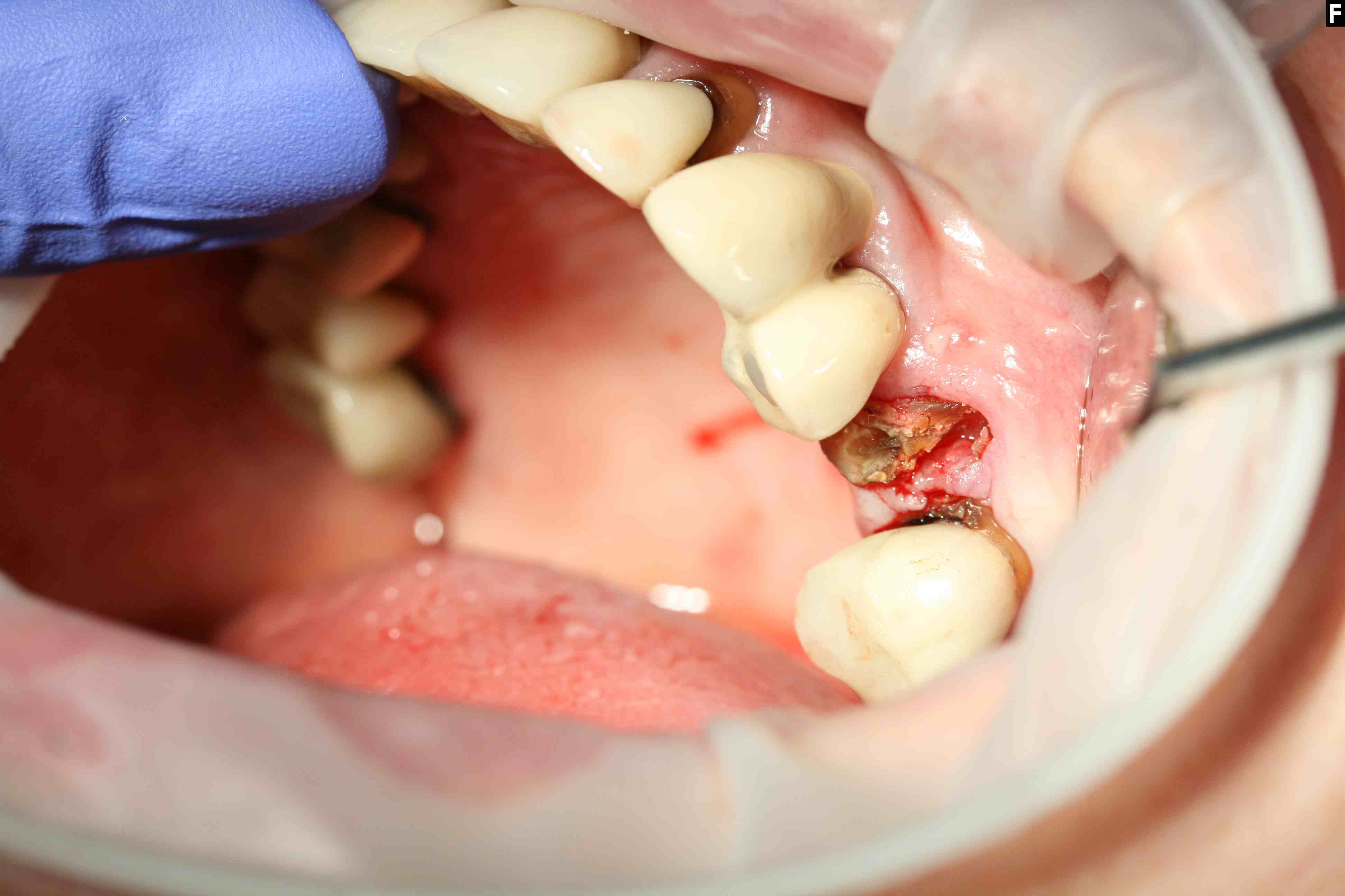 Dental News - Atraumatic extraction of maxillary second premolar