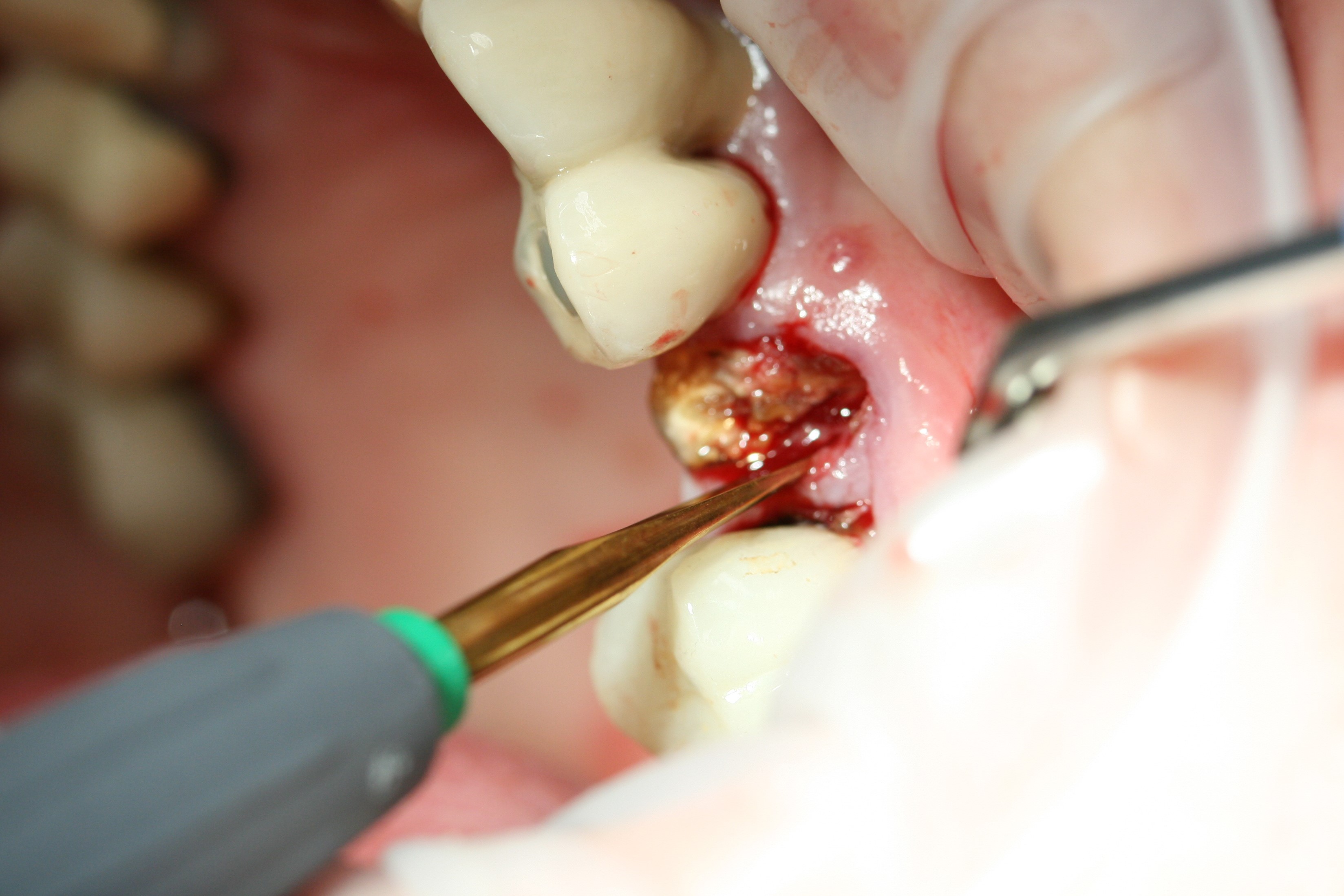 Dental News - Atraumatic extraction of maxillary second premolar