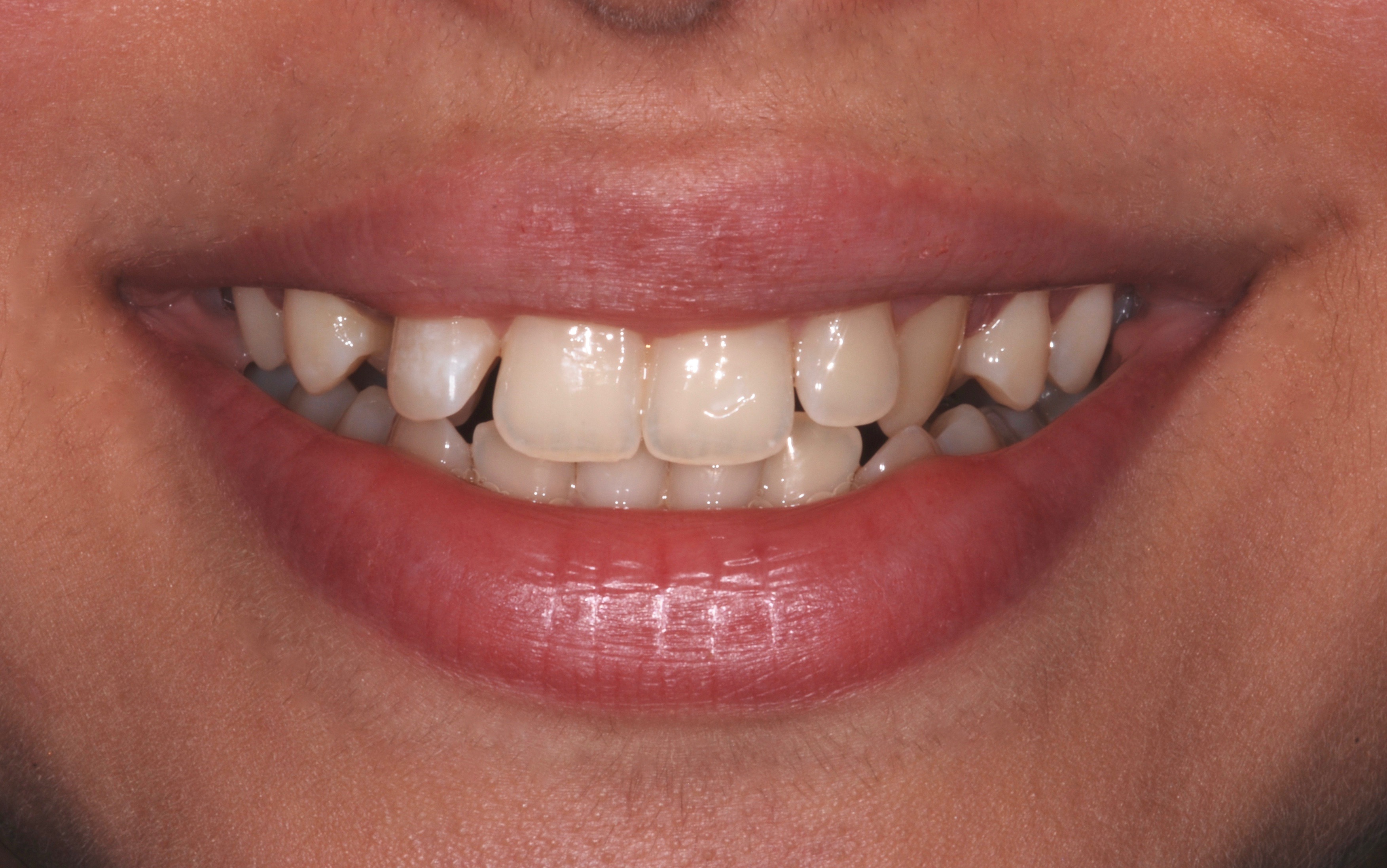 Dental News - Streamlining clear aligner therapy–Success without ...